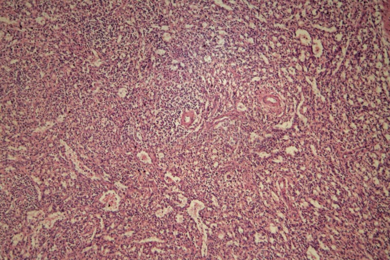 Human Spleen with Chronic Myelogenous Leukemia Stock Image - Image of ...