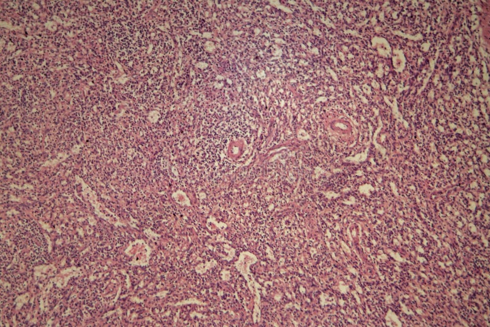 Human Spleen with Chronic Myelogenous Leukemia Stock Image - Image of ...