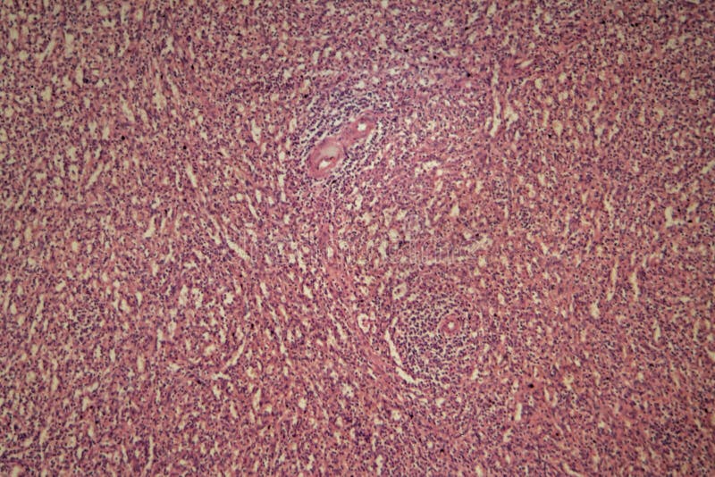 Human Spleen with Chronic Myelogenous Leukemia Stock Image - Image of ...