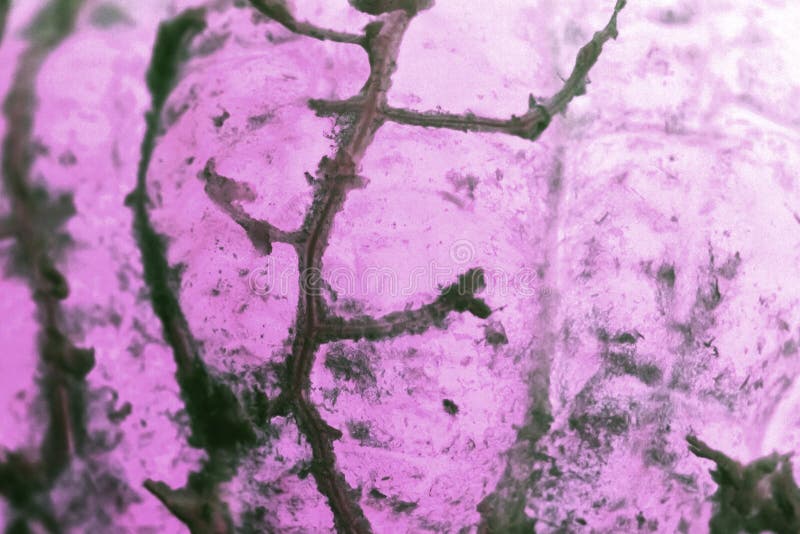 Squamous Cell Carcinoma Of The Lung Stock Photo - Image of carcinoma ...