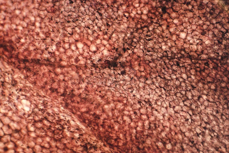 Human Squamous Cell Carcinoma. Tissues Affected by Cancer Cells Under a ...