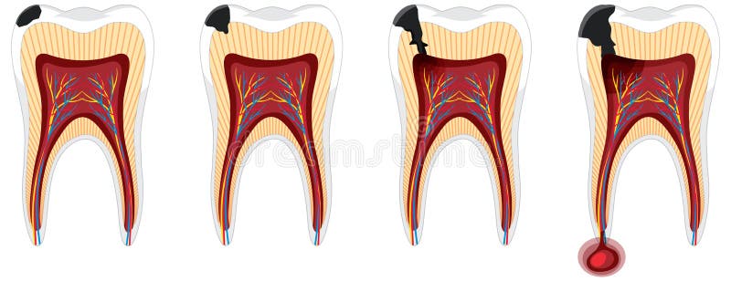 Human in the Stages of Tooth Decay Stock Vector - Illustration of ...