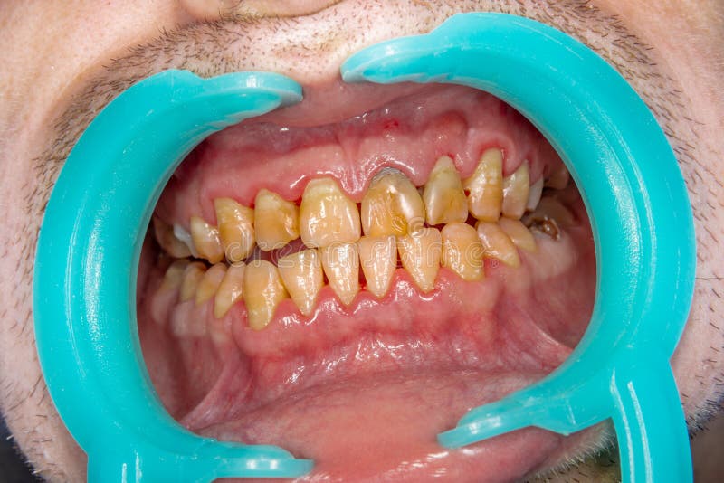 Human Teeth Closeup With Dental Plaque And Inflammation Of Gingivitis ...