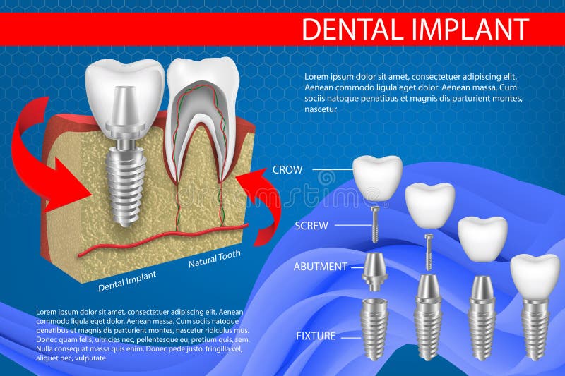Human Teeth and Dental Implant Vector in Gum Mockup. Stock Vector ...