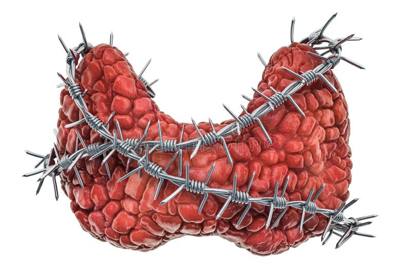 Human Thyroid with Shackle. Thyroid Disease Concept Stock Illustration ...