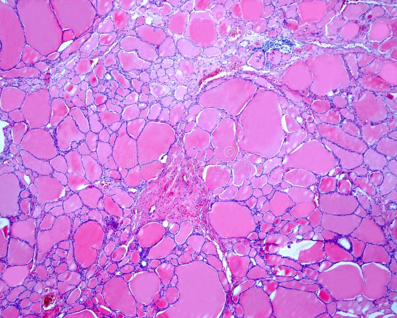 Human Thyroid Gland. Diffuse Goiter Stock Photo - Image of microscopy ...