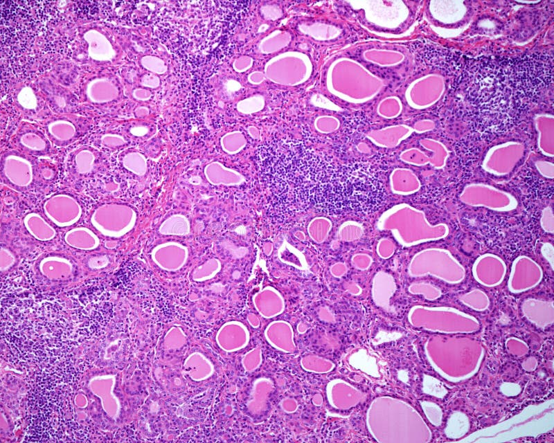Human Thyroid. Hashimoto Disease Stock Photo - Image of hashimoto ...