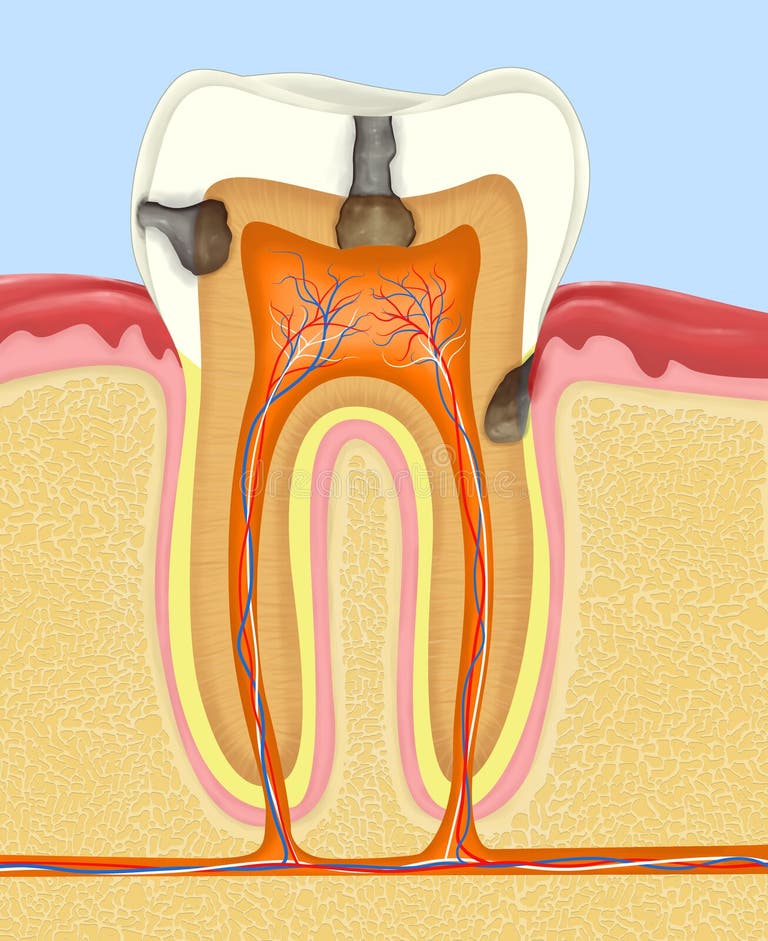 Rotten Tooth Stock Illustrations – 343 Rotten Tooth Stock Illustrations ...