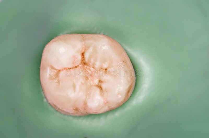 Human Tooth - caries stock photo. Image of inflammation - 13984208