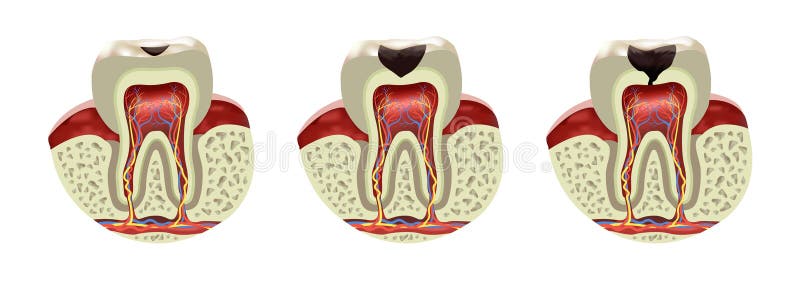 Human Tooth Decay Disease Cross Section Realistic View Stock ...