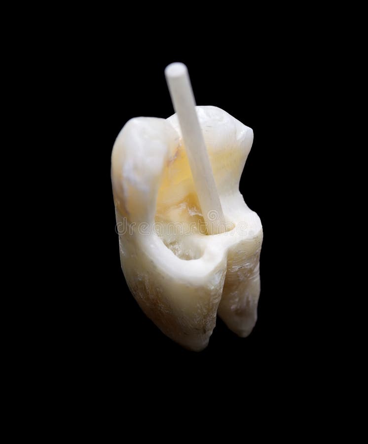 Real Human Wisdom teeth stock image. Image of medical - 12121451