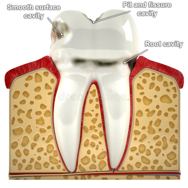 Human Tooth, with Types of Caries (3d Model) Stock Illustration ...