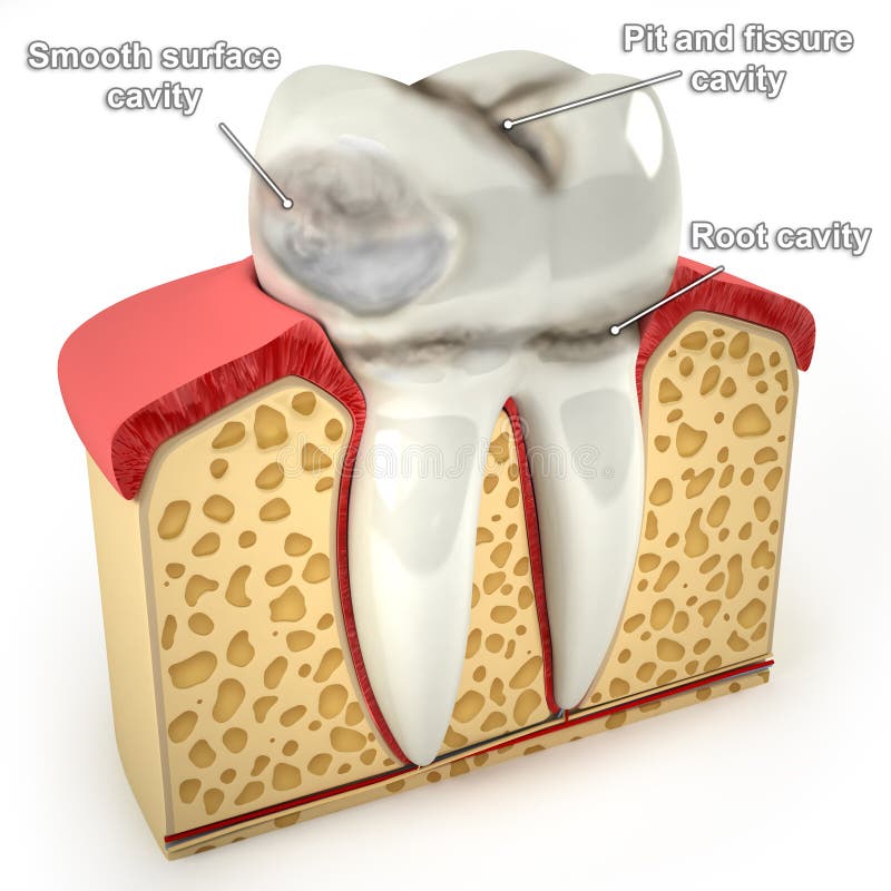 Human Tooth, with Types of Caries (3d Model) Stock Illustration ...