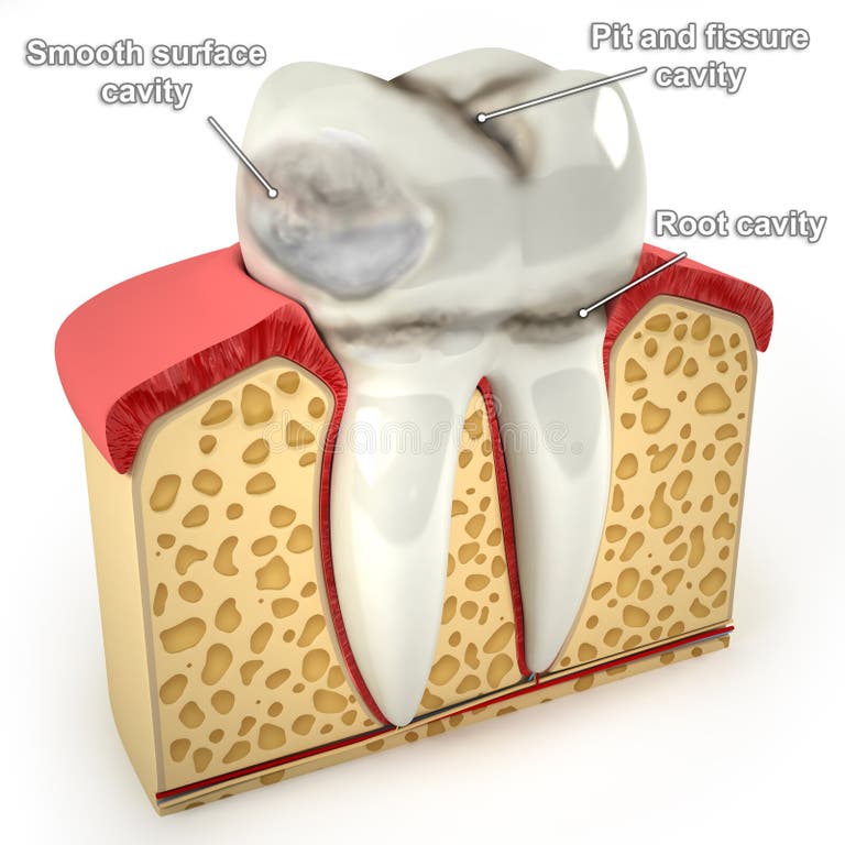 Human Tooth, with Types of Caries (3d Model) Stock Illustration ...