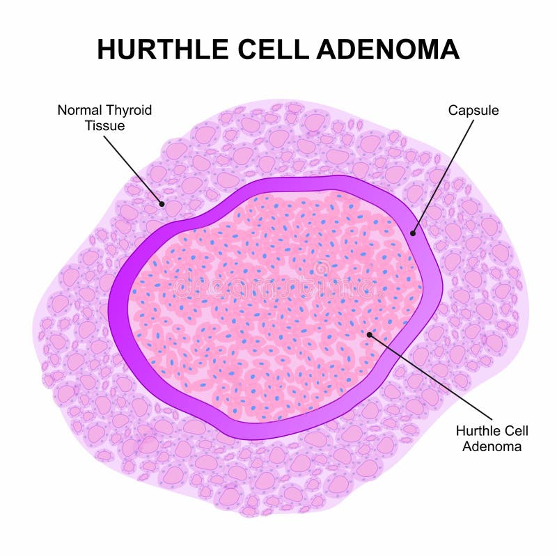 Hurthle Cells Stock Illustrations – 1 Hurthle Cells Stock Illustrations ...