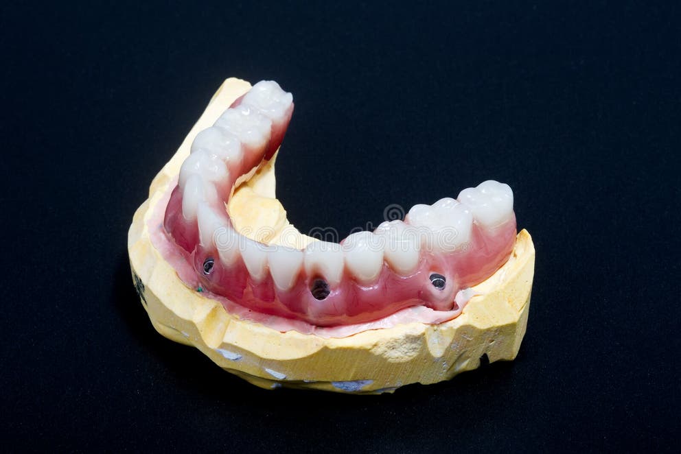 Hybrid Dental Prosthesis on Implants Stock Image - Image of pink ...