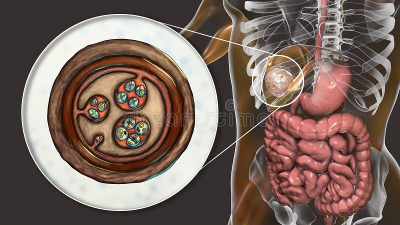 Hydatid Cyst of Echinococcus Granulosus in the Liver Stock Illustration ...