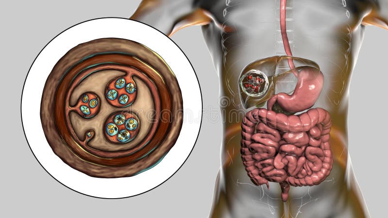 Hydatid Cyst of Echinococcus Granulosus in the Liver Stock Illustration ...