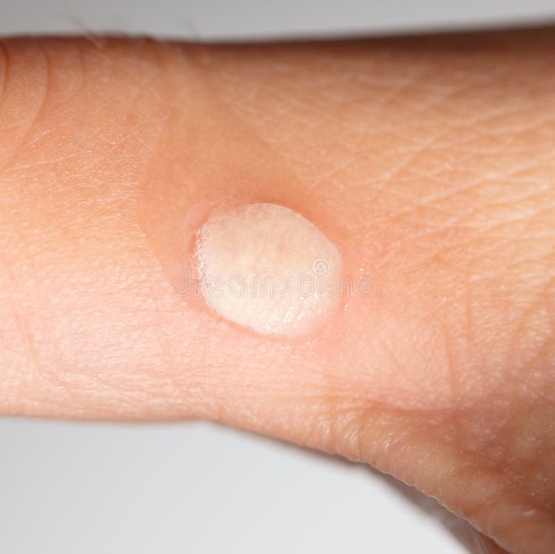 Corn On The Skin. The Corn Popped. Treatment Of Wound With Hydrogen ...