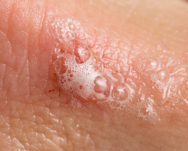 Hydrogen Peroxide on Human Skin. Macro Stock Photo - Image of hand ...