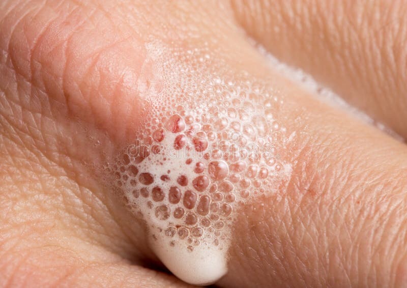 Hydrogen Peroxide on Human Skin. Macro Stock Image - Image of white ...