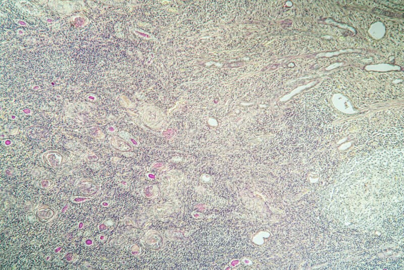 Hydronephrosis Kidney Inflammation in Tissue Section Stock Image ...