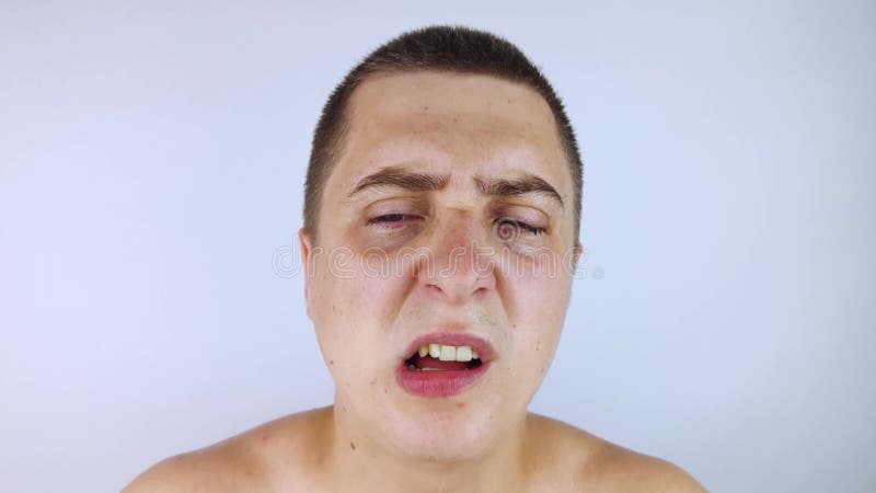 A Man with Sweating on His Face is Looking at the Camera. Sweat Gland ...