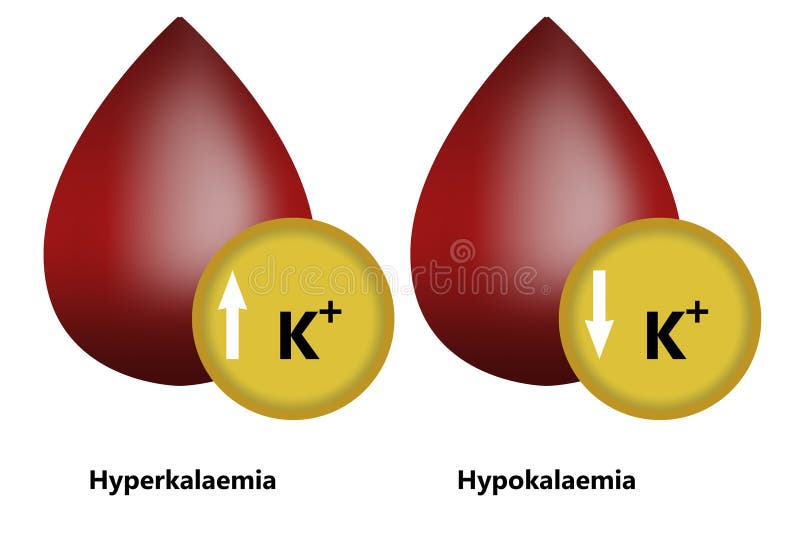 Hyperkalaemia and Hypokalaemia with Blood Shape Stock Illustration ...