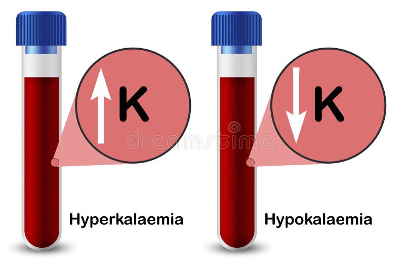 Hyperkalaemia Stock Illustrations – 5 Hyperkalaemia Stock Illustrations ...