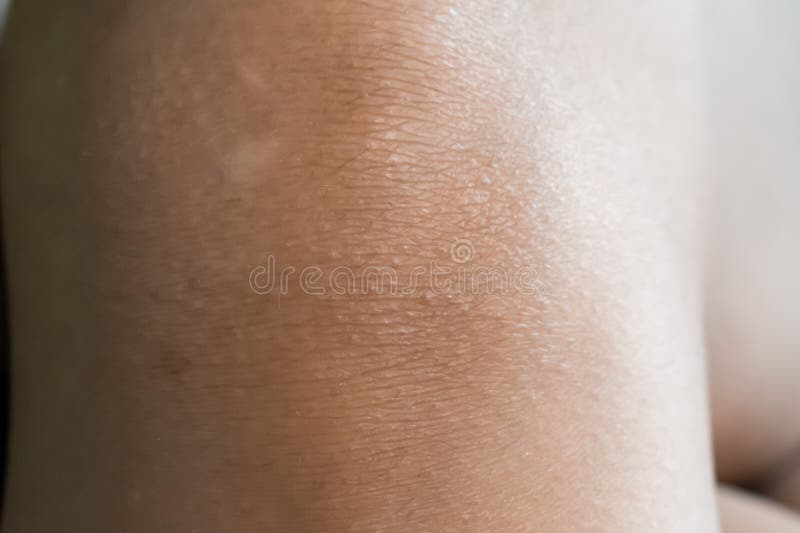 Keratosis Pilaris Stock Photos - Free & Royalty-Free Stock Photos from ...