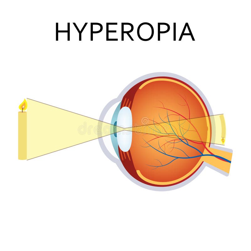 Hyperopia Eyesight Disorder. Stock Vector - Illustration of farsighted ...