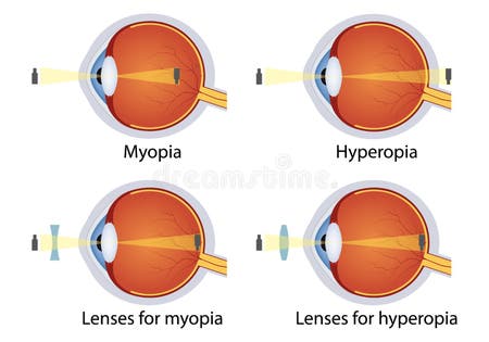Hyperopia and Myopia Corrected by Lens. Concept of Eyes Defect Stock ...