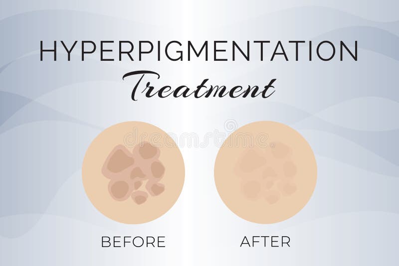 Hyperpigmentation Treatment before and after Illustration Design Stock ...