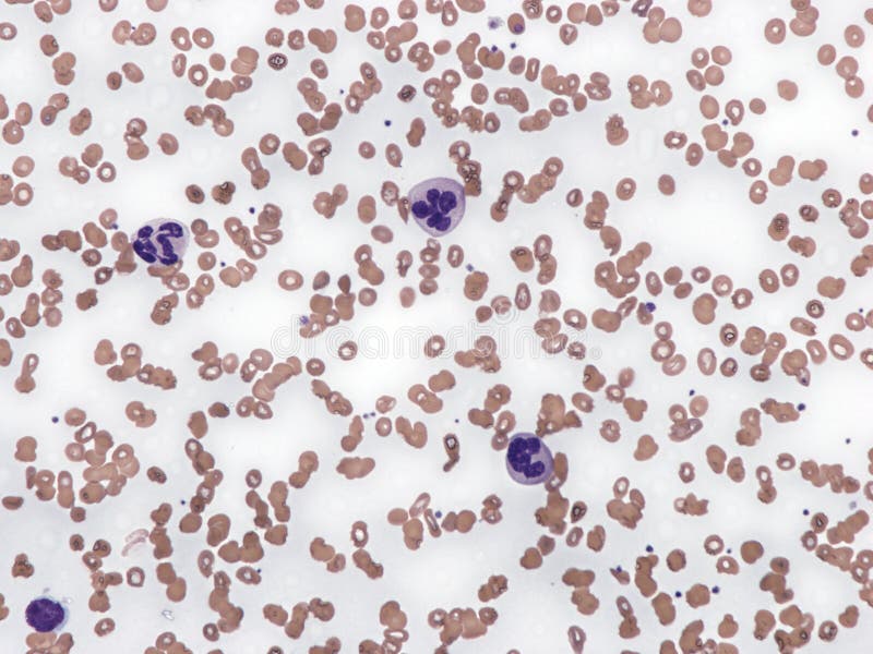 Hypersegmented Neutrophils. Peripheral Blood. Stock Image - Image of ...