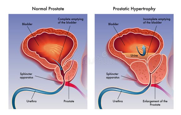 Hypertrophie De La Prostate Illustration de Vecteur - Illustration du ...