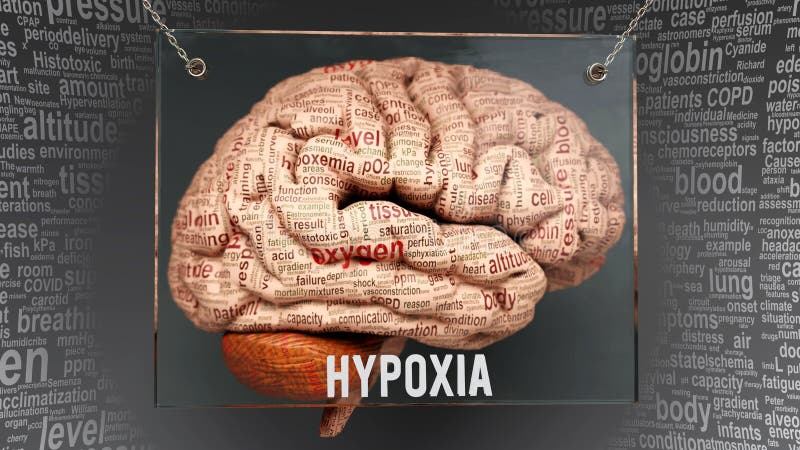 Hypoxia Ideas Stock Illustrations – 6 Hypoxia Ideas Stock Illustrations ...