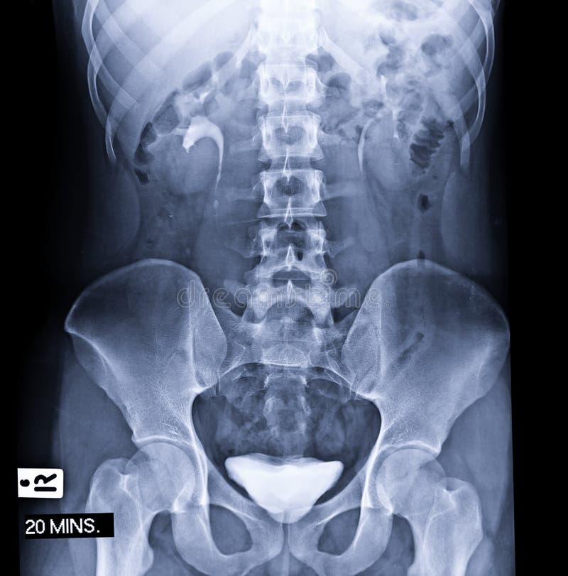 Ivp Intravenous Pyelogram Ten Minutes After Administration Of