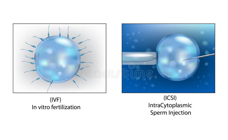 Cytoplasmic Sperm Injection Stock Illustrations – 16 Cytoplasmic Sperm ...