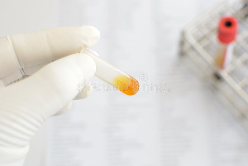 Icteric serum stock image. Image of icteric, healthcare - 33263267