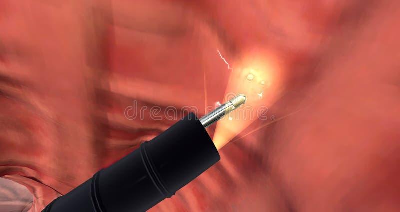 If Abnormal-looking Tissue is Spotted during a Colonoscopy, a Biopsy ...