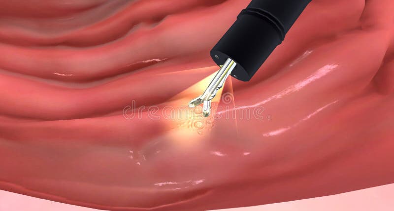 If Abnormal-looking Tissue is Spotted during an Upper Endoscopy, a ...