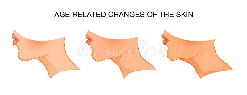 Illustration of Age-related Skin Changes. Aging Stock Vector ...