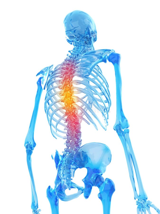 Illustration of backache stock illustration. Illustration of inflamed ...