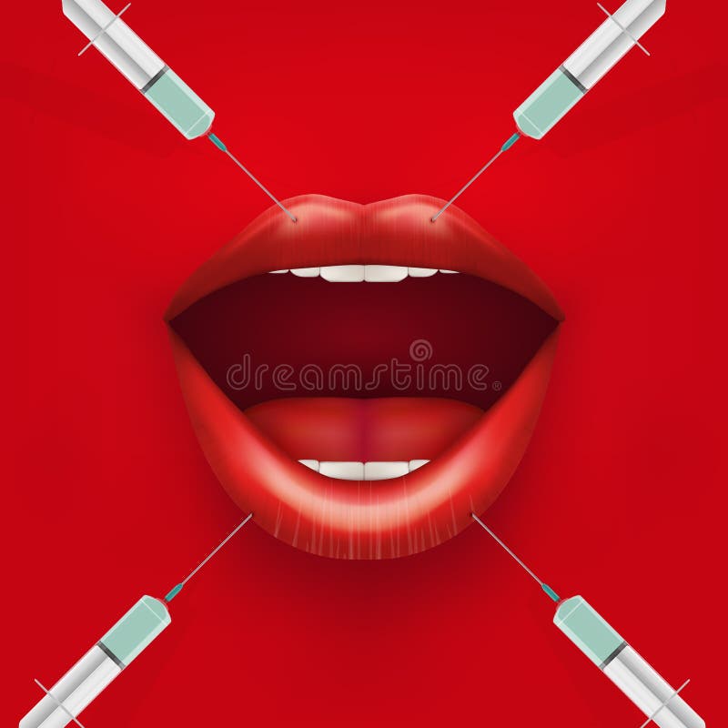 Illustration of a Botox Injection. Stock Illustration - Illustration of ...