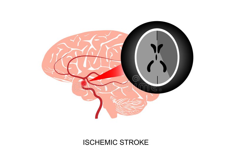 Illustration of Cerebral Ischemic Stroke and Imaging Stock Illustration ...