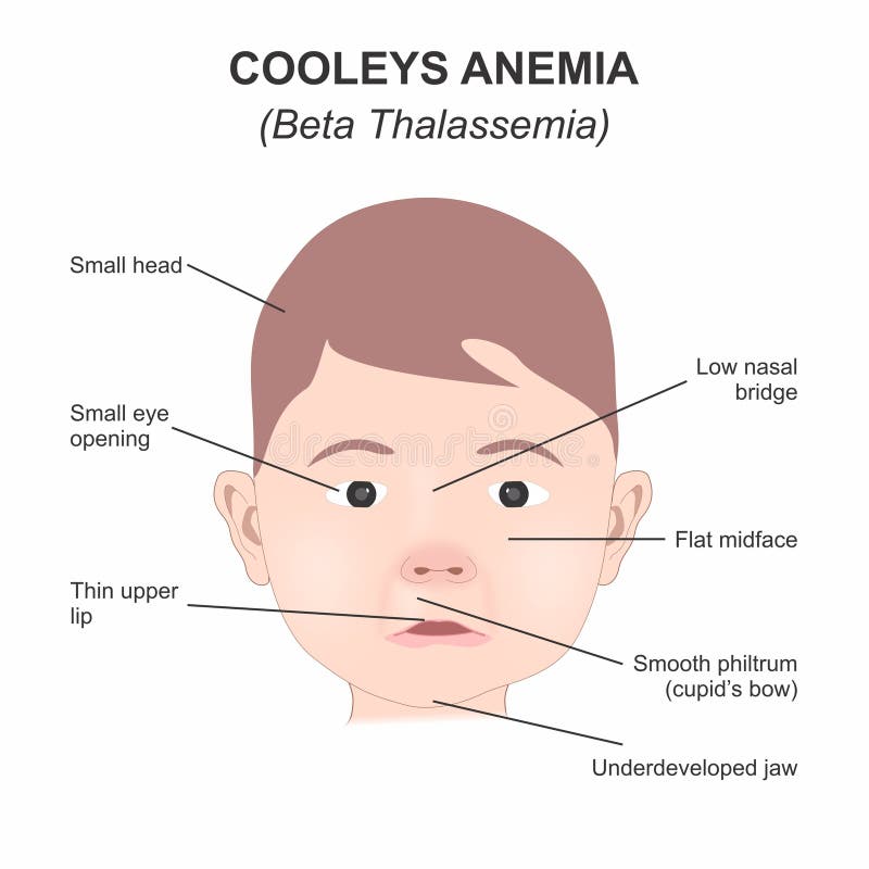 Cooleys Anemia (Beta Thalassemia) Stock Image - Illustration of nose ...