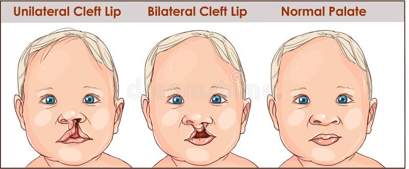 Cleft Lip and Cleft Palate. Vector Art, Illustration. Stock Vector ...