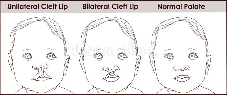 Illustration of a Cleft Palate in a Child. Plastic Surgery Stock Vector ...