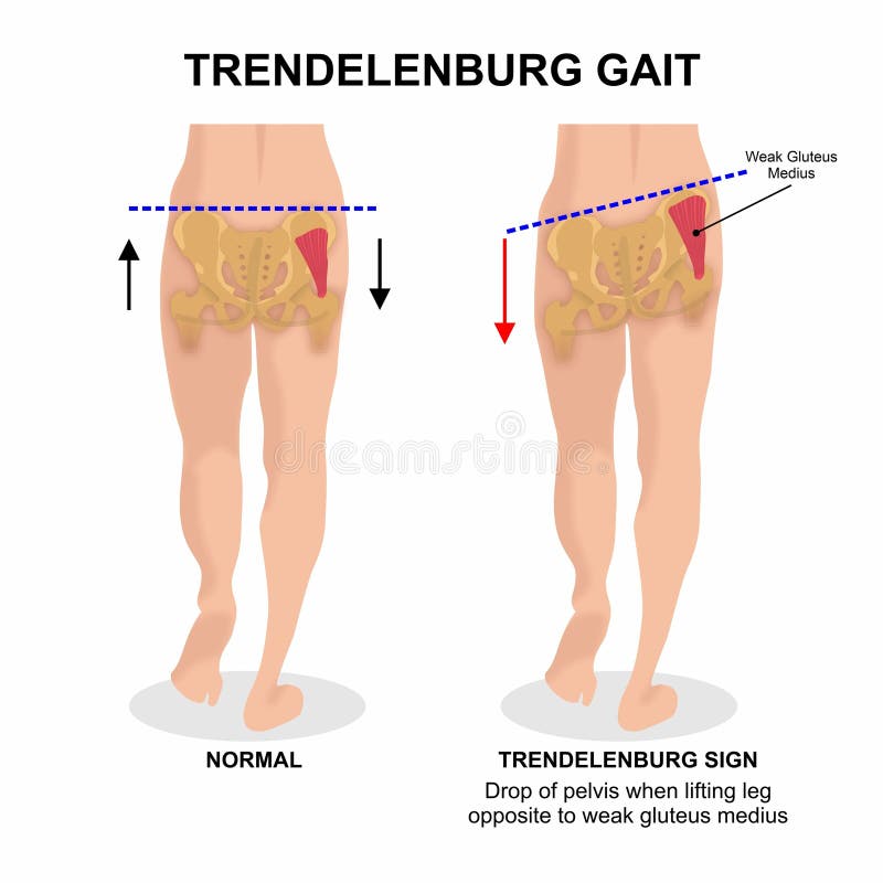 Trendelenburg Gait Illustration Stock Photo - Illustration of limb, dress: 391883022