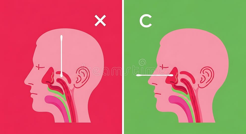 Insertion Technique Stock Illustrations – 83 Insertion Technique Stock ...